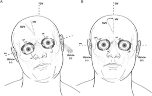 Videonistagmografia (VNG) Video-oculografia (VOG) | Tiziano Guadagnin
